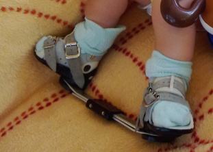 Dorsi Ramp equinovarus